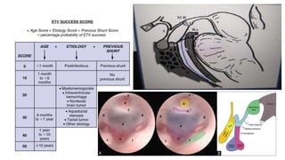 Endoscopic 3rd Ventriculostomy-DR.MUMTAZ ALI NAREJO.pptx
