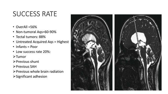 Endoscopic 3rd Ventriculostomy-DR.MUMTAZ ALI NAREJO.pptx