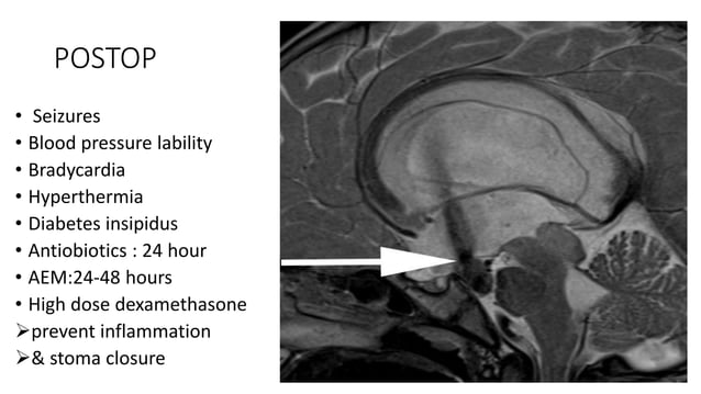 Endoscopic 3rd Ventriculostomy-DR.MUMTAZ ALI NAREJO.pptx