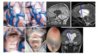 Endoscopic 3rd Ventriculostomy-DR.MUMTAZ ALI NAREJO.pptx