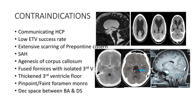 Endoscopic 3rd Ventriculostomy-DR.MUMTAZ ALI NAREJO.pptx