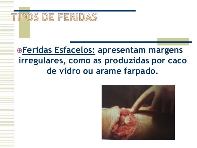 Feridas