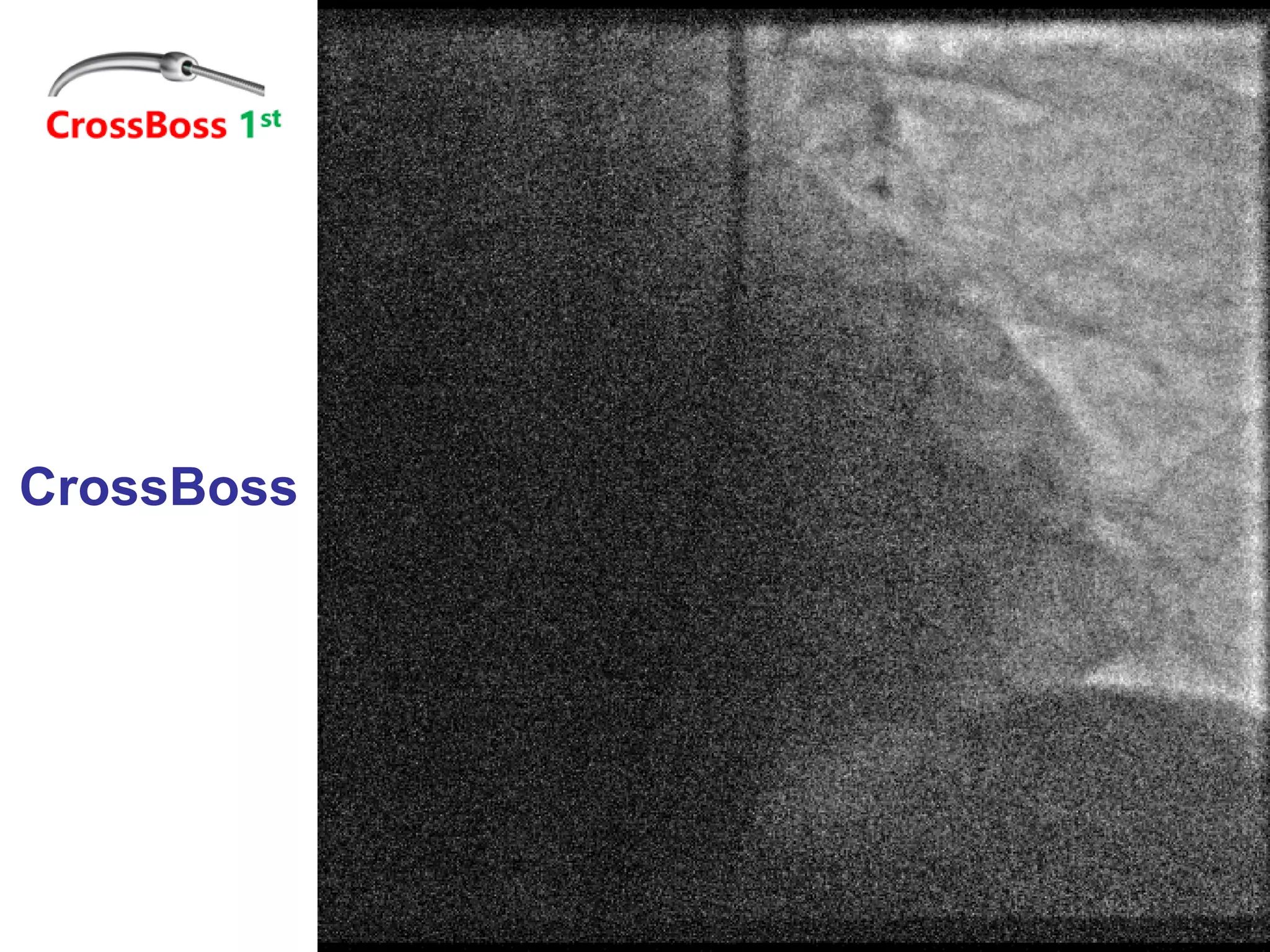 Emmanouil S. Brilakis - Antegrade dissection re-entry step by step | PDF