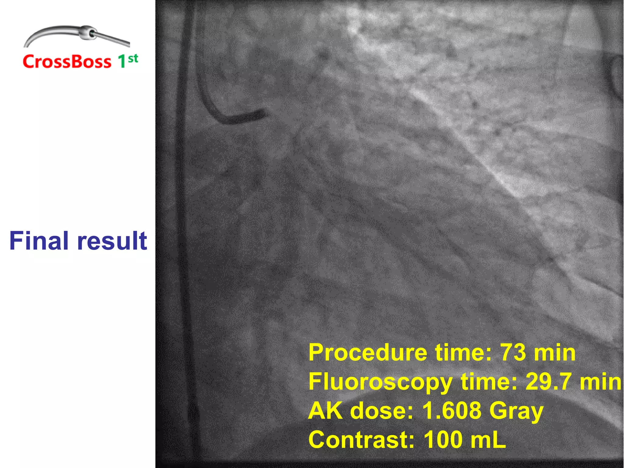 Emmanouil S. Brilakis - Antegrade dissection re-entry step by step | PDF