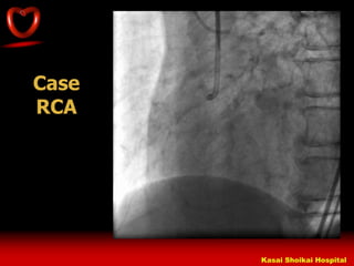 08:30 Asakura - How to Succeed in Reverse - CART Technique | PPTX