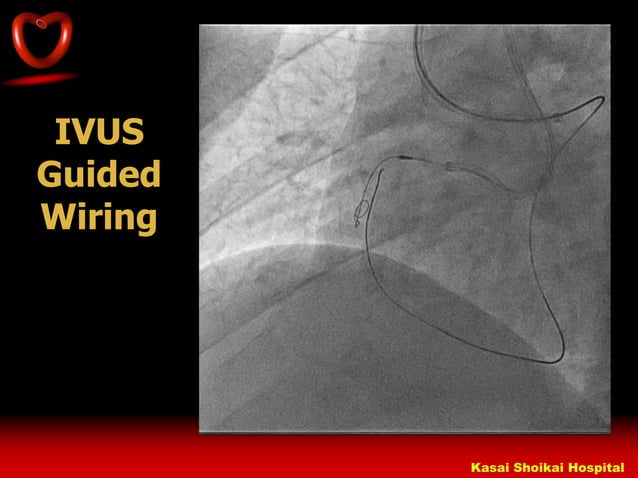 08:30 Asakura - How to Succeed in Reverse - CART Technique | PPTX