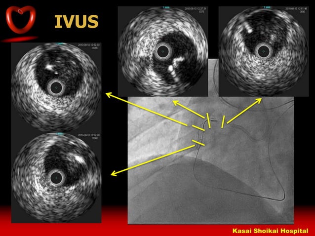 08:30 Asakura - How to Succeed in Reverse - CART Technique | PPTX