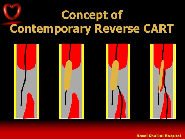 08:30 Asakura - How to Succeed in Reverse - CART Technique