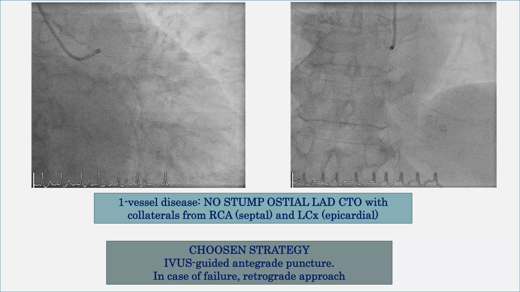 IVUS guided recanalization of a no stump LAD CTO where the distal cap ...