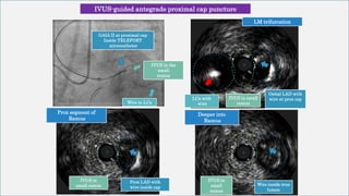 IVUS guided recanalization of a no stump LAD CTO where the distal cap ...