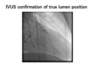 Parallel wire using dual-lumen catheters | PPTX