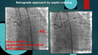 5 most important things you can do wrong in the retrograde approach | PPT