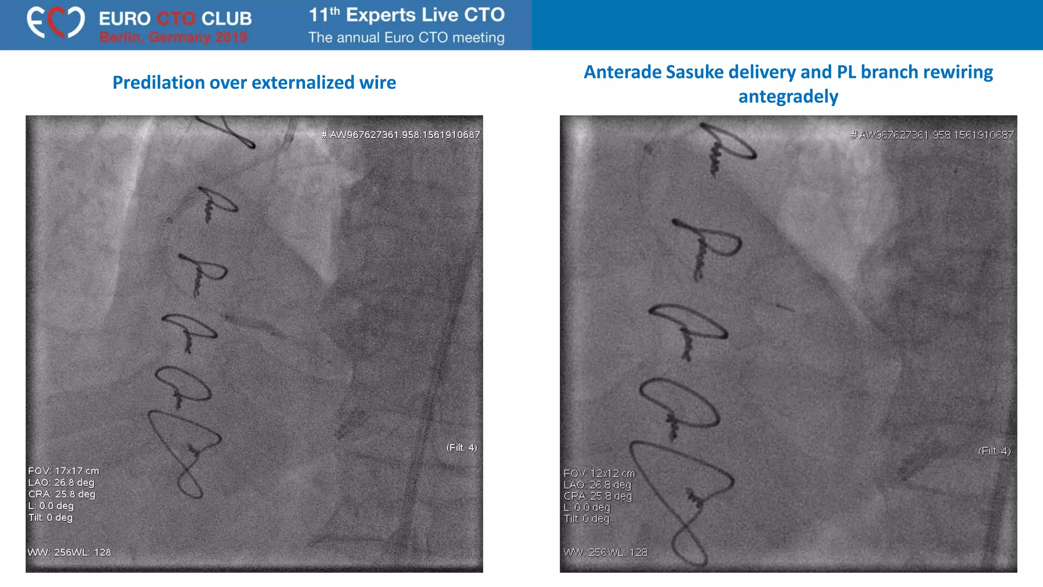 Application of retrograde dual lumen microcatheter for a chronic total ...