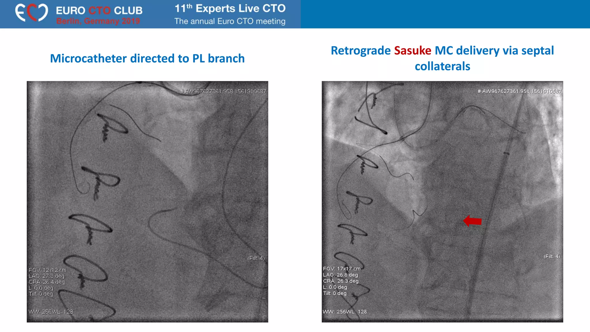 Application of retrograde dual lumen microcatheter for a chronic total ...