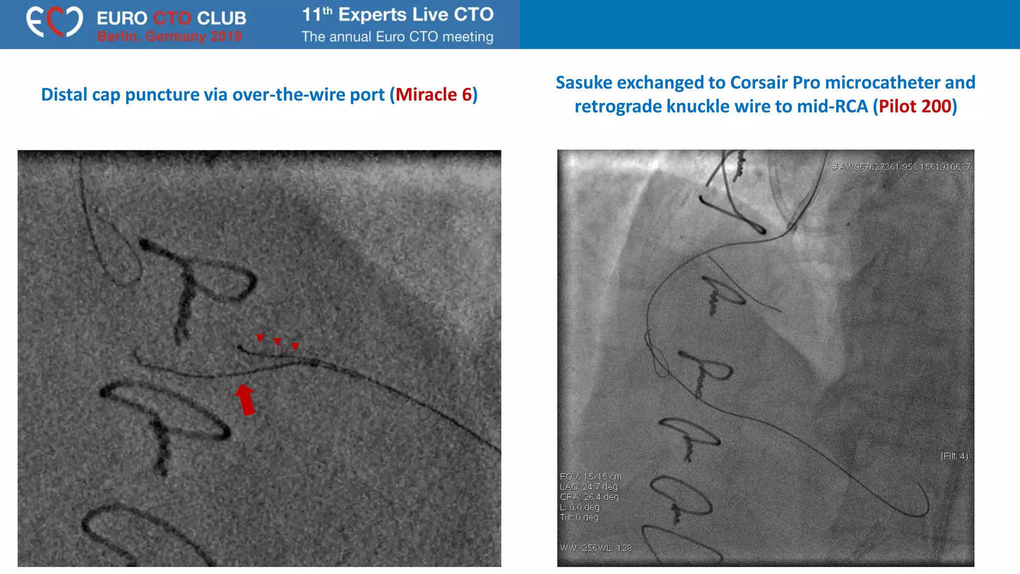 Application of retrograde dual lumen microcatheter for a chronic total ...