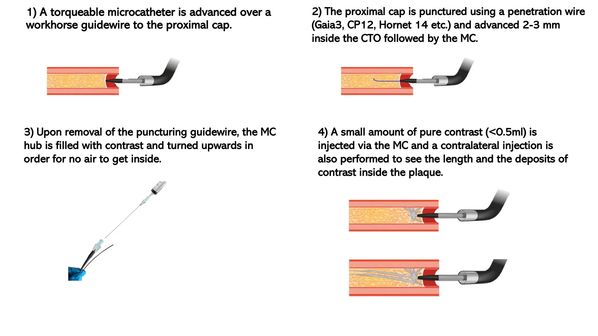 How did the HydroDynamic Contrast Recanalization technique changed my ...