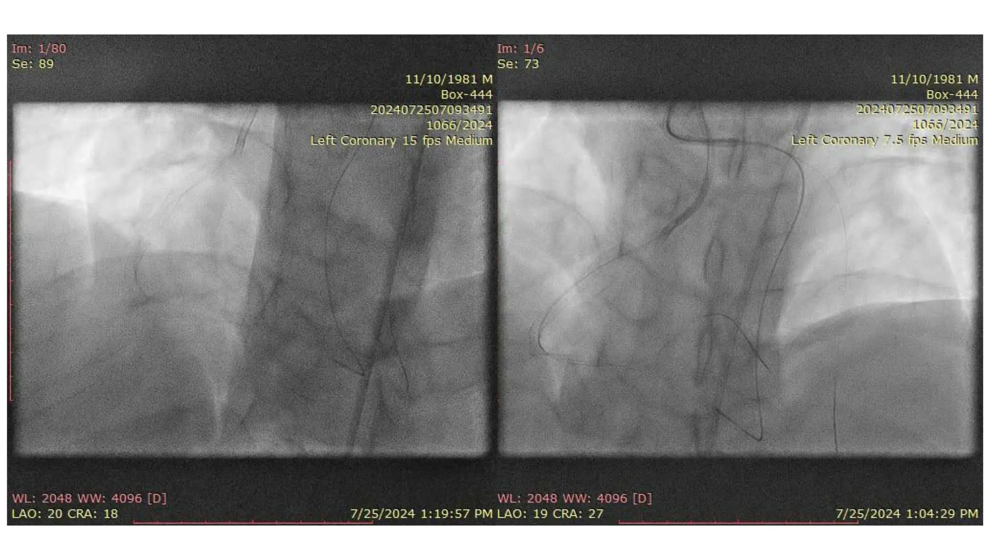 How did the HydroDynamic Contrast Recanalization technique changed my ...