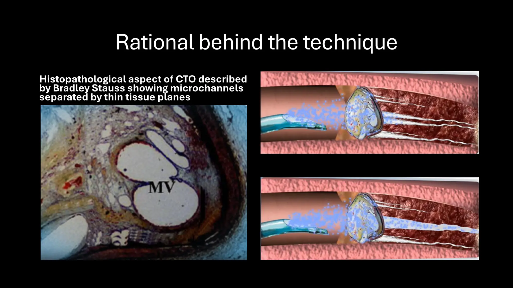 How did the HydroDynamic Contrast Recanalization technique changed my ...