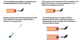 How did the HydroDynamic Contrast Recanalization technique changed my ...