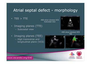 Euroecho2010 intracardiac-shunts | PDF | Heart and Cardiovascular ...
