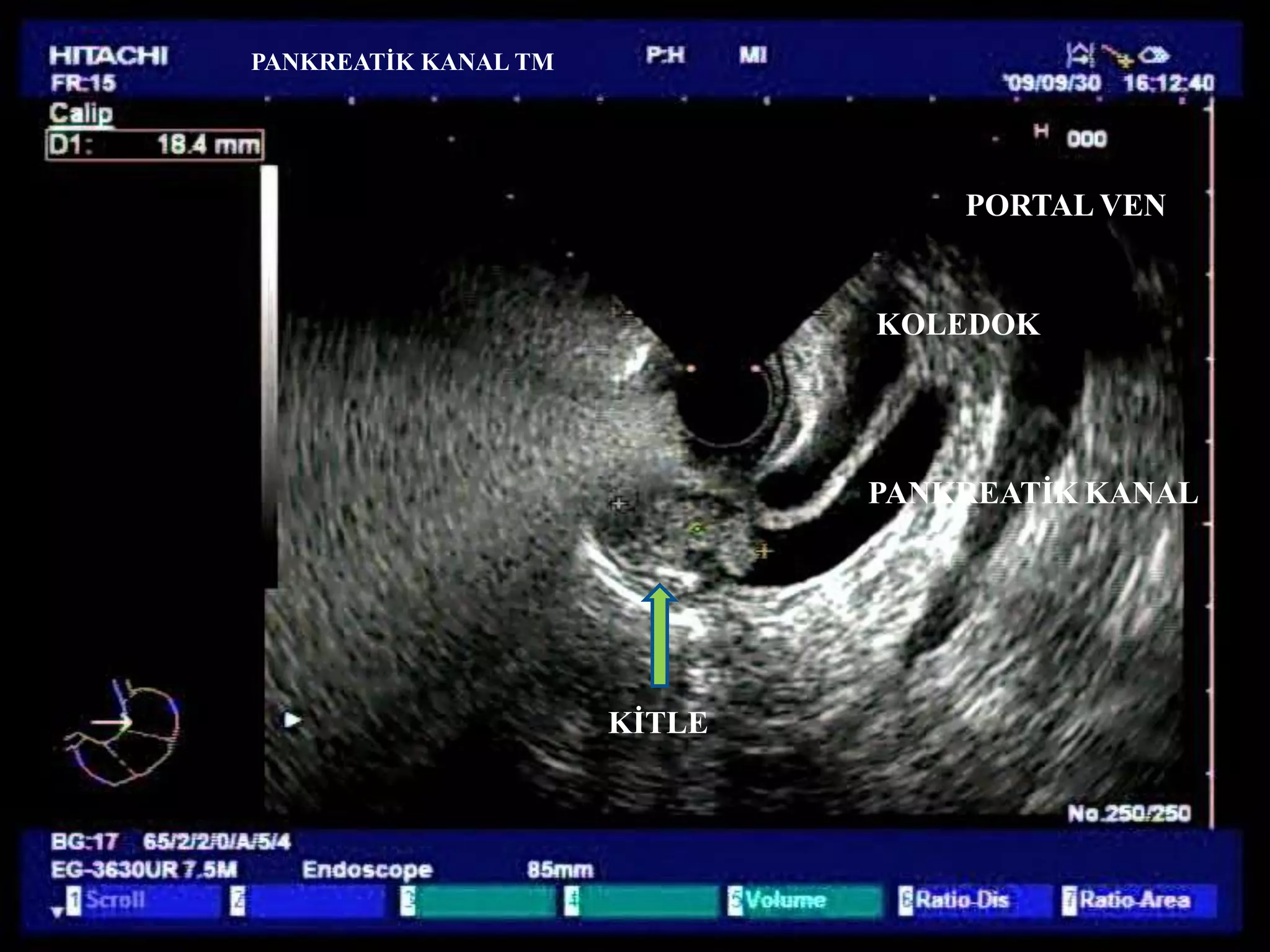 Cfare eshte endosonografia. | PPTX