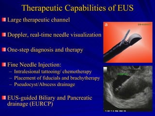 EUS Guided Anti Tumor Therapyversion0 | PPT