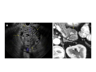 EUS in Pancreatic cystic lesions.pptx