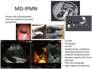 EUS in Pancreatic cystic lesions.pptx