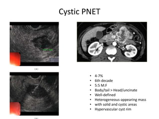 EUS in Pancreatic cystic lesions.pptx