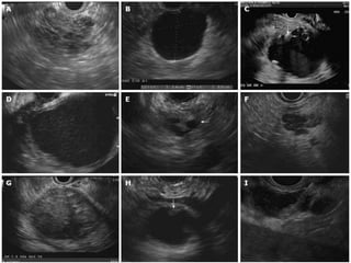EUS in Pancreatic cystic lesions.pptx