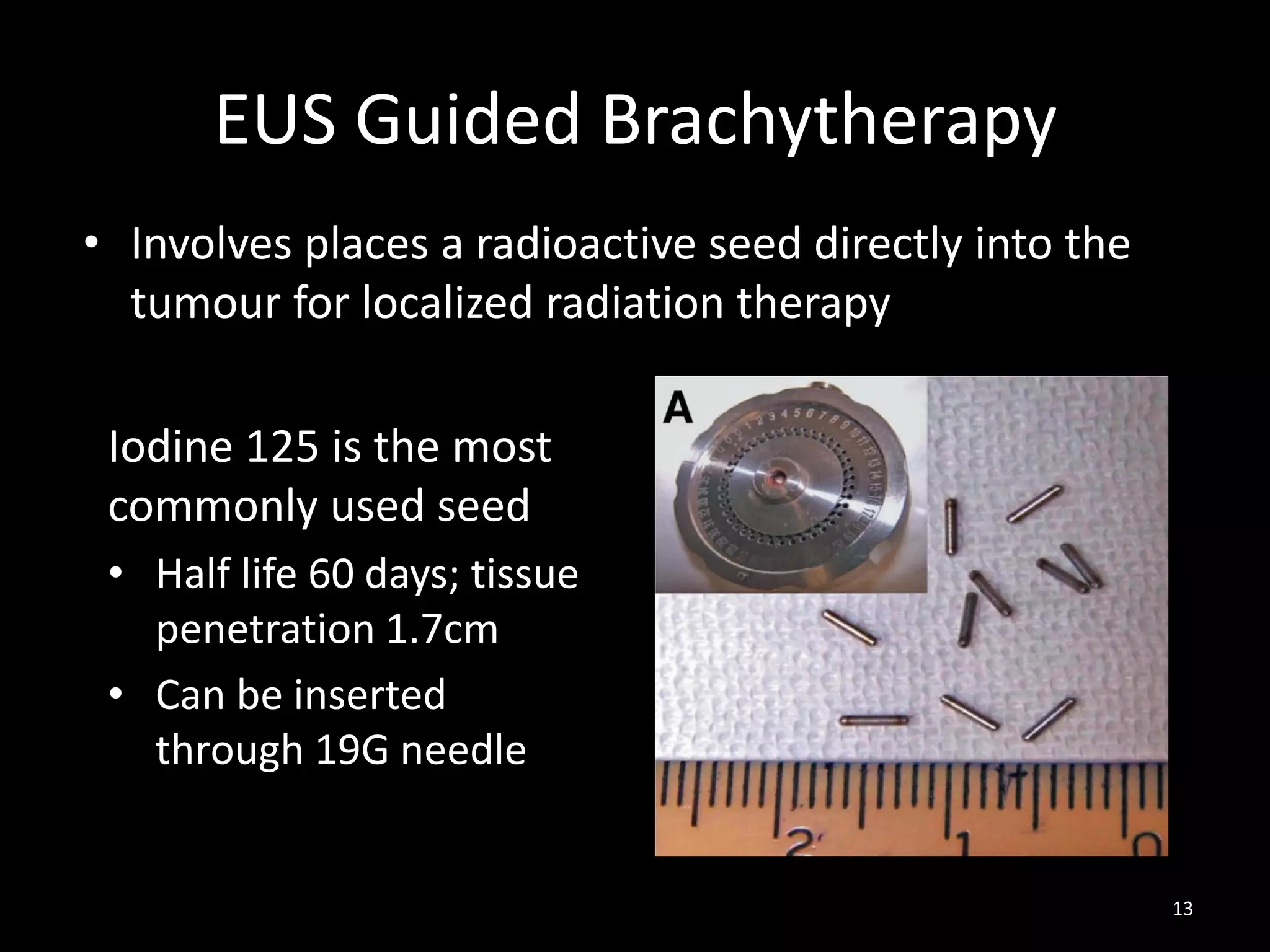 EUS Guided Interventions for Pancreatobiliary Tumours | PDF
