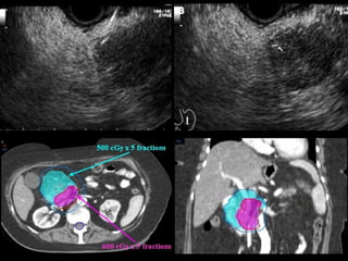 EUS Guided Interventions for Pancreatobiliary Tumours | PDF