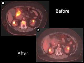 EUS Guided Interventions for Pancreatobiliary Tumours | PDF