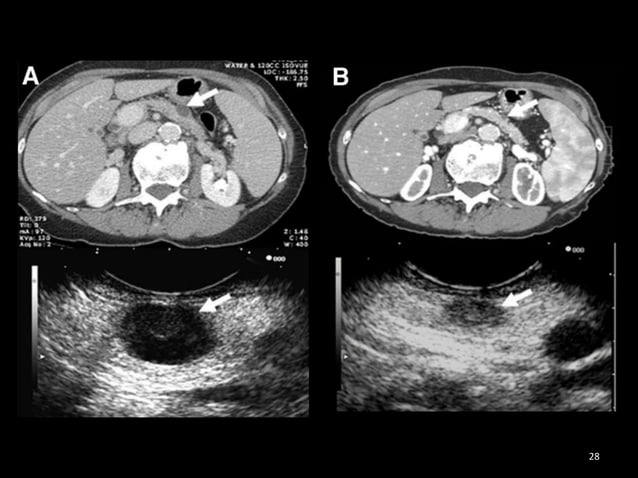 EUS Guided Interventions for Pancreatobiliary Tumours | PDF | Digestive ...