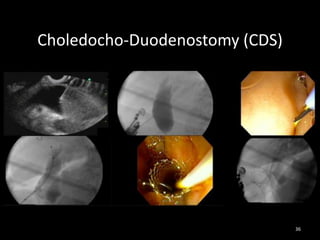 EUS Guided Interventions for Pancreatobiliary Tumours | PDF