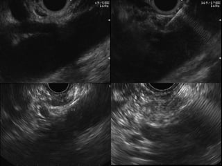 EUS Guided Interventions for Pancreatobiliary Tumours | PDF