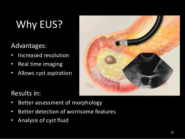 EUS Guided Interventions for Pancreatobiliary Tumours