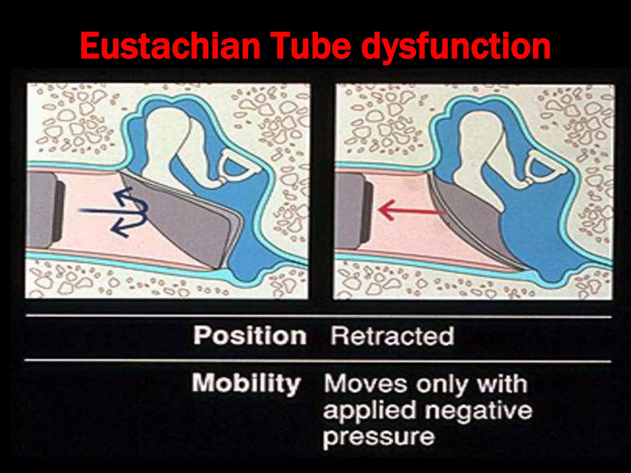 Eustachian tube disorders by Dr. Krishna Koirala | PPT | Ear, Nose and ...