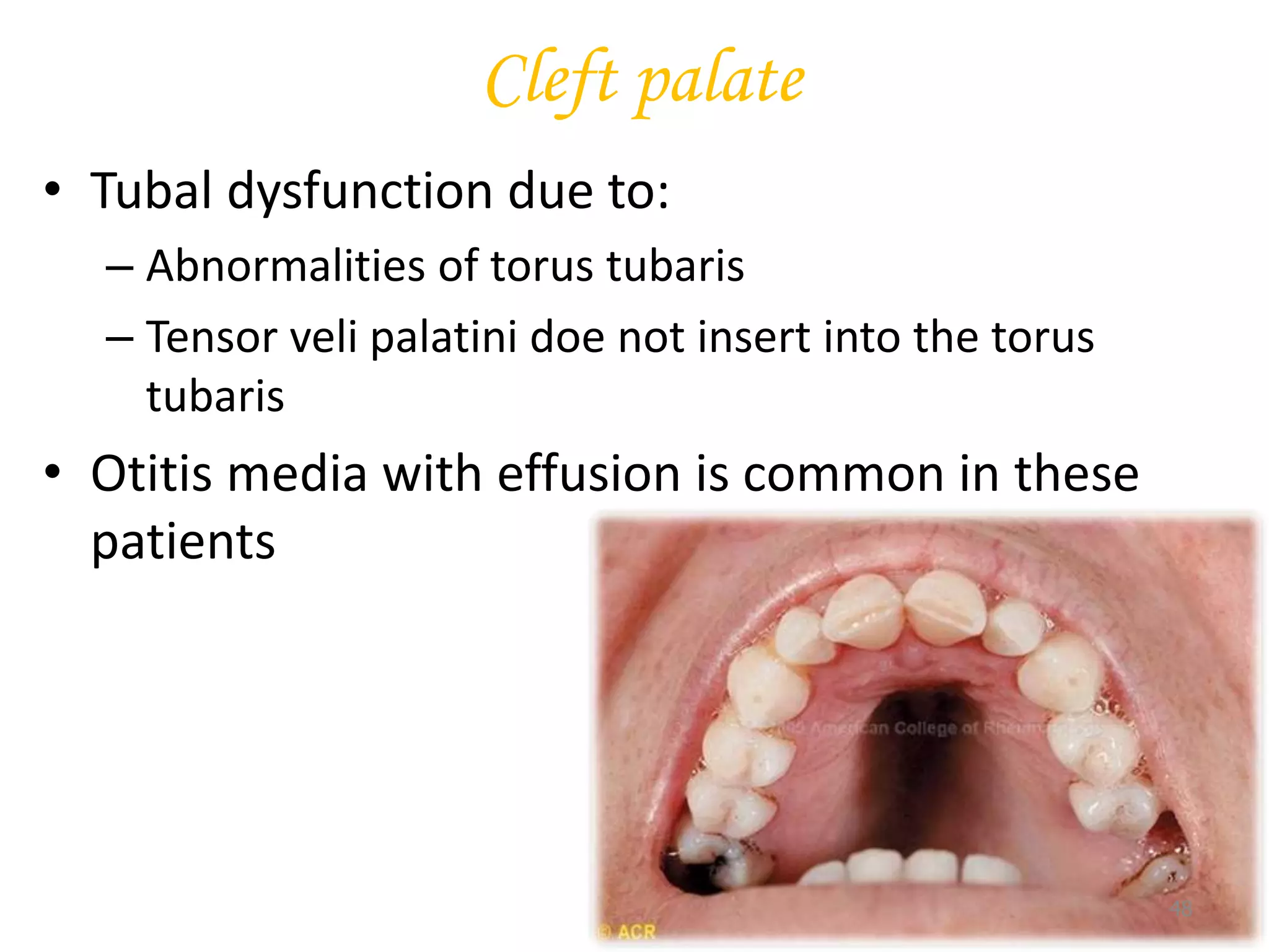 Eustachian tube, anatomy, test and disorders, dr.vijaya sundarm, 20.03.17