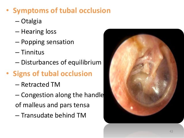 Eustachian Tube Dysfunction Tympanic Membrane Pin On Drain