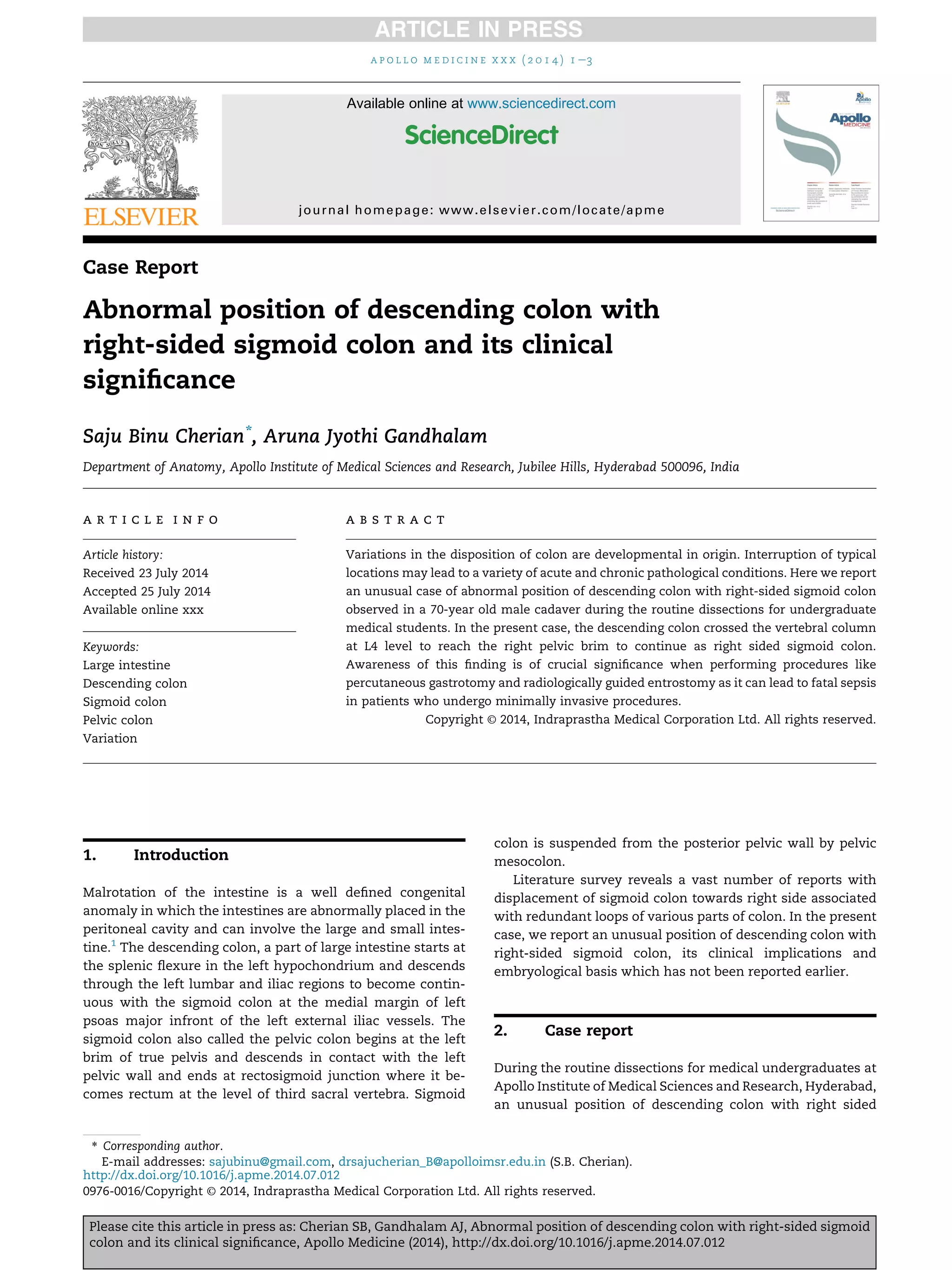 Abnormal position of descending colon with right-sided sigmoid colon ...