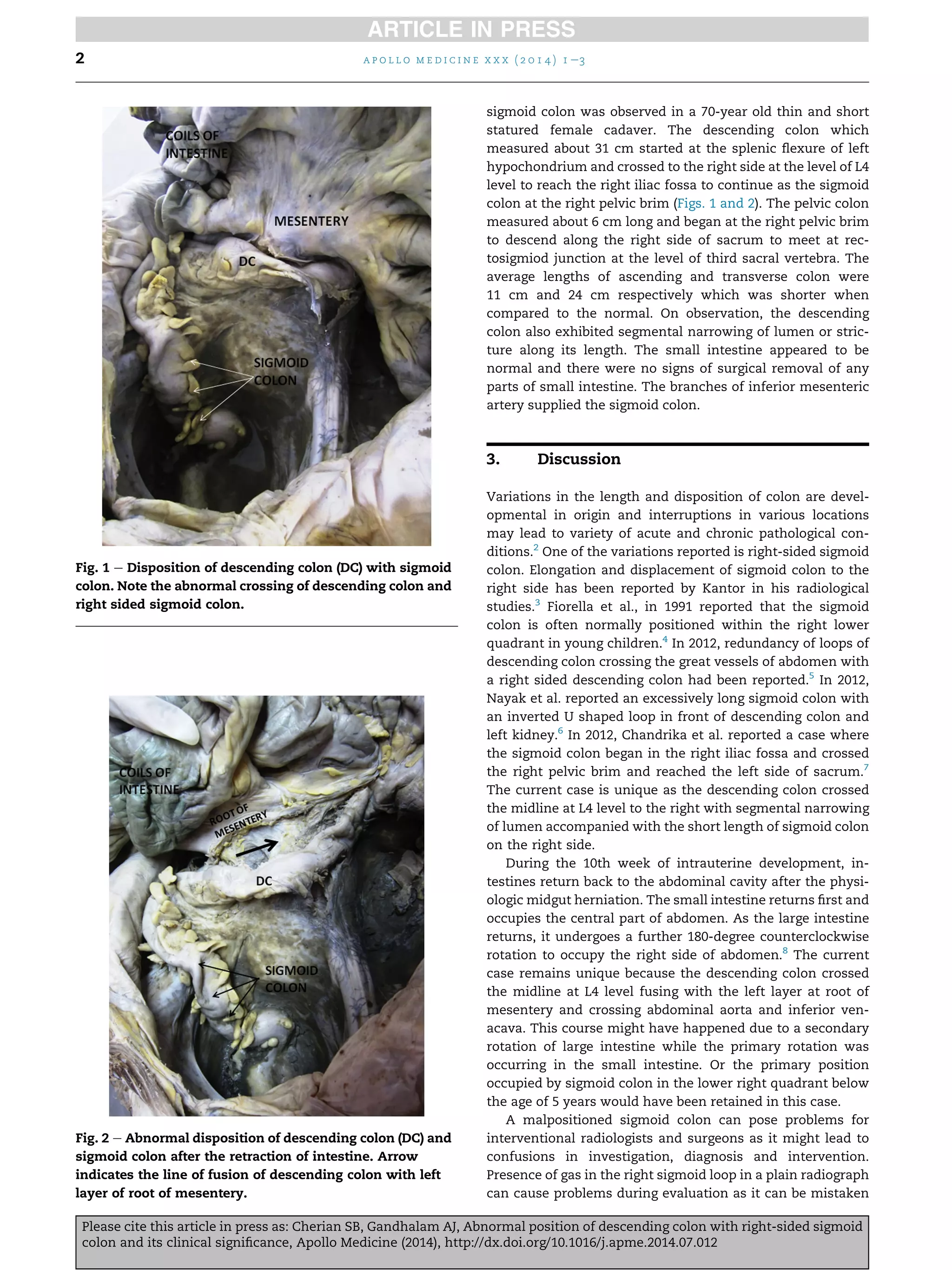 Abnormal position of descending colon with right-sided sigmoid colon ...