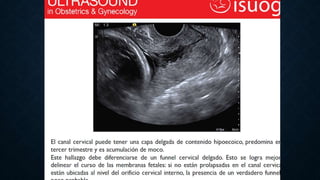 Evaluación de la longitud cervical | PPTX