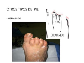 EVALUACIÓN DEL PIE (6).pdf descripción tipos | PDF