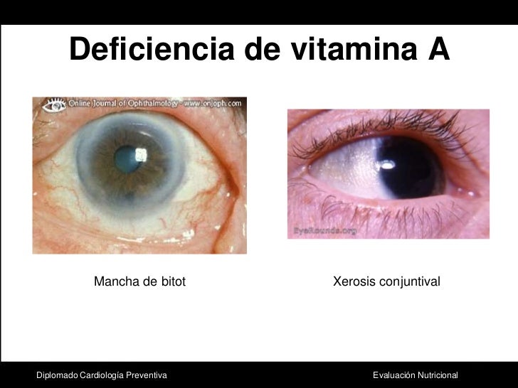 SEMINARIO INTERDISCIPLINARIO GRUPO 2016-2: HW. CEGUERA. AMANDA NALLELY ...