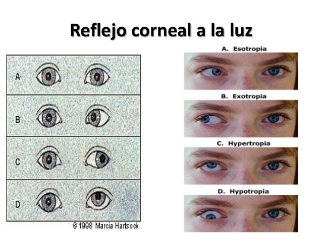 Evaluación oftalmológica