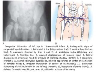 Evaluación radiográfica de la pelvis | PPTX