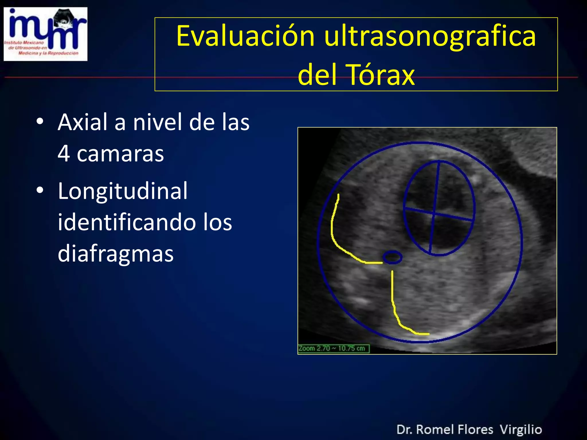Evaluacion del torax fetal por ultrasonido. dr. romel flores | PDF ...