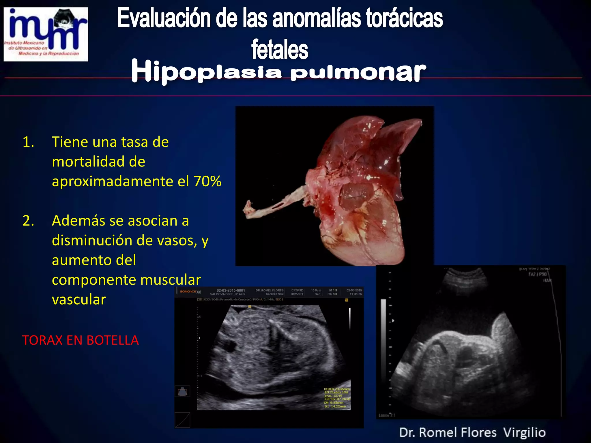 Evaluacion del torax fetal por ultrasonido. dr. romel flores | PDF ...
