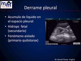Evaluacion del torax fetal por ultrasonido. dr. romel flores | PDF